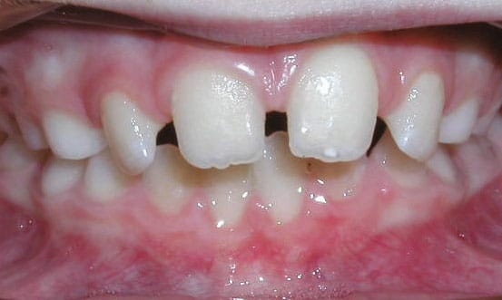 Common Orthodontic Problems Staten Island NY Metuchen NJ